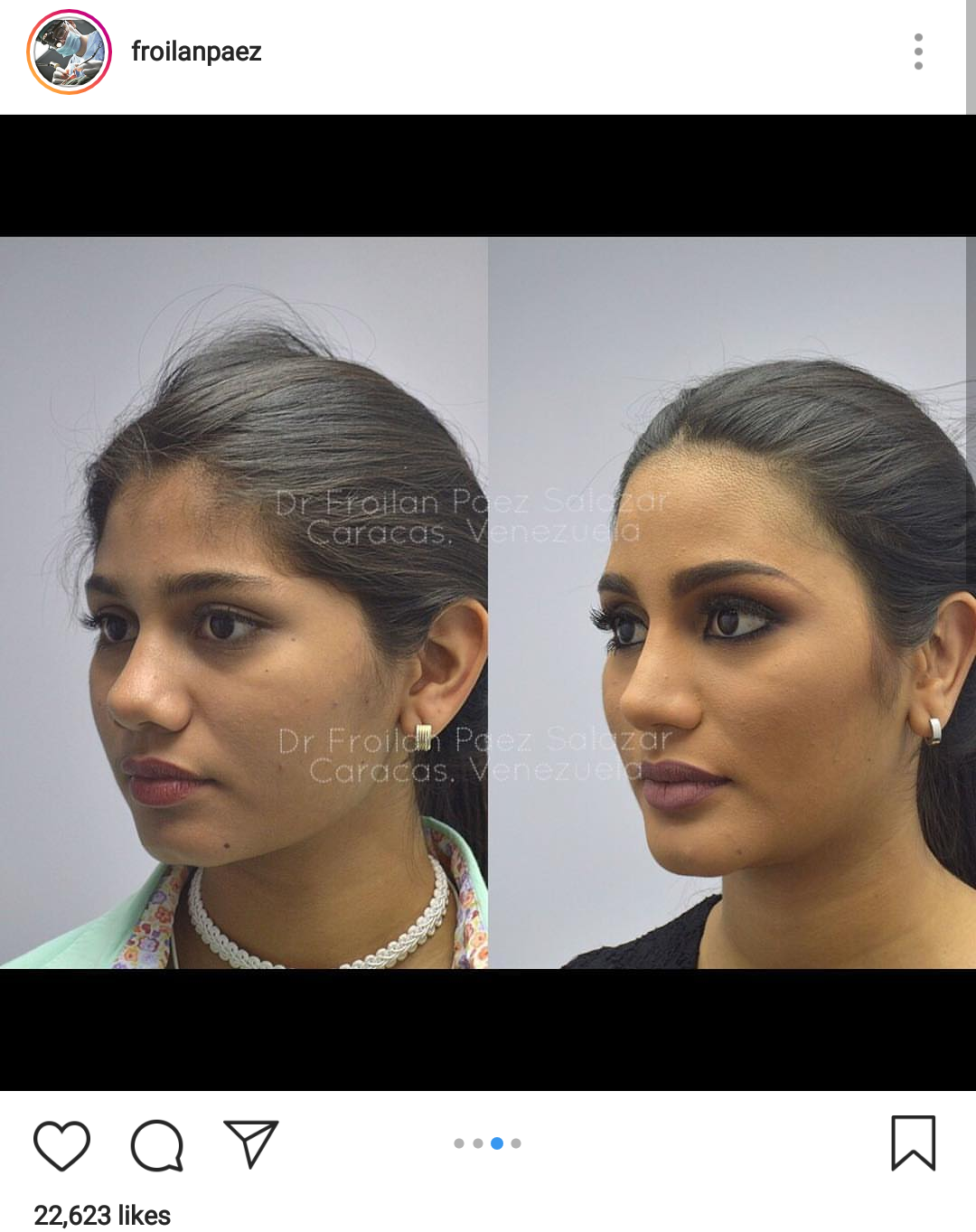 Before and after photos of Venezuelan beauty queens circulate on social ...