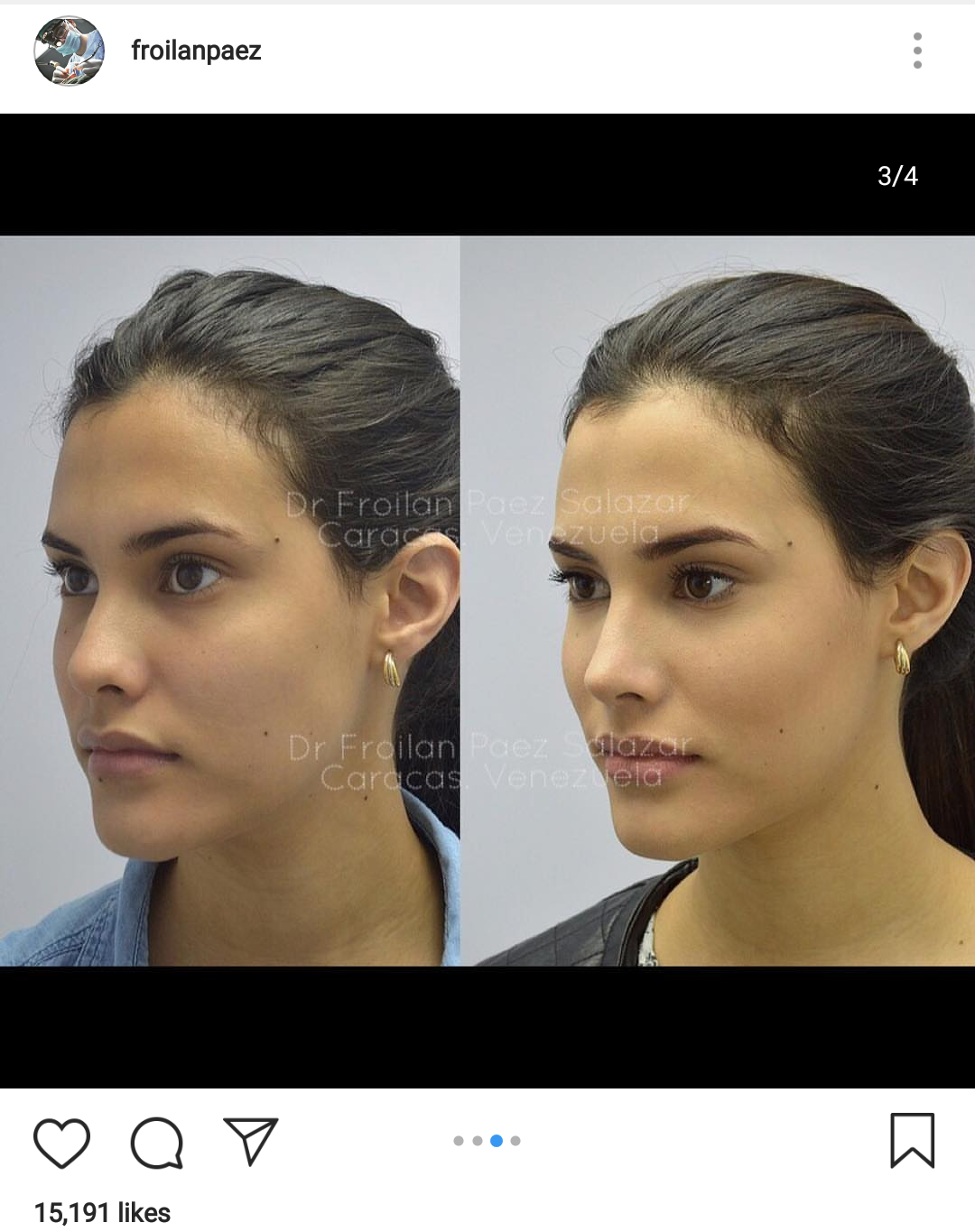 Before and after photos of Venezuelan beauty queens circulate on social ...