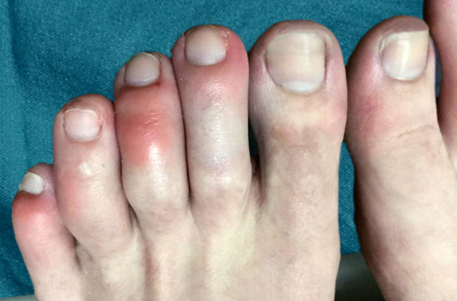 'COVID-19 toes': Scientists discover new coronavirus symptom - The ...