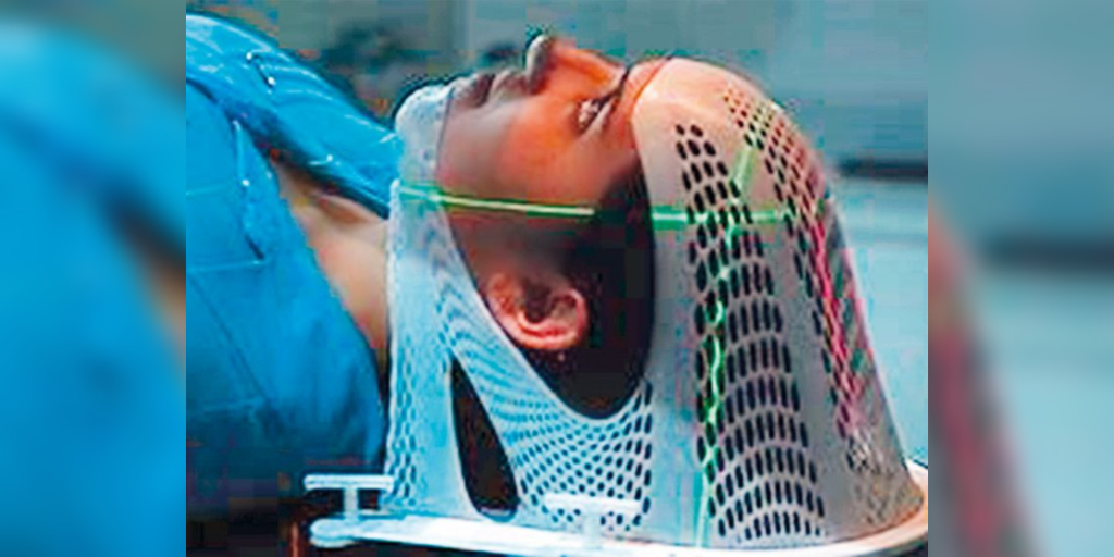 ACOC: Stereotactic radiosurgery for Benign Intracranial Tumors - The ...